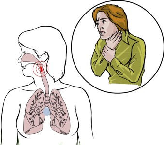 Choking Quiz: How Do You Respond When Someone Is Choking
